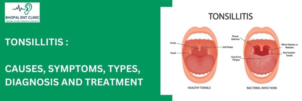 Expert treatment for Tonsillitis at the Bhopal by Dr. Sadat Qureshi.